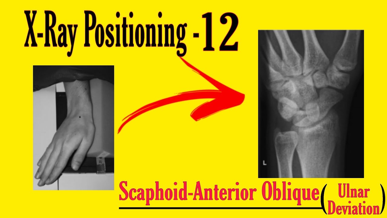 Scaphoid X Ray Positioning | X Ray Positioning for Radiographers ...