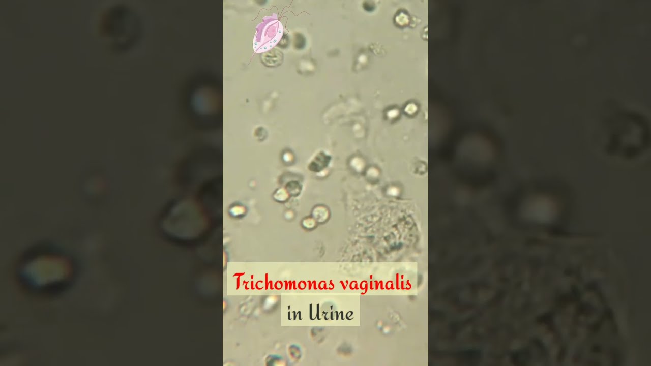 trichomonas vaginalis in urine #shorts - YouTube
