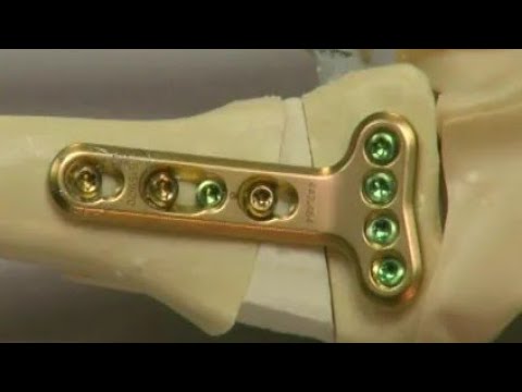 Radius, Distal – Malunion of an Extraarticular Fracture - Corrective ...