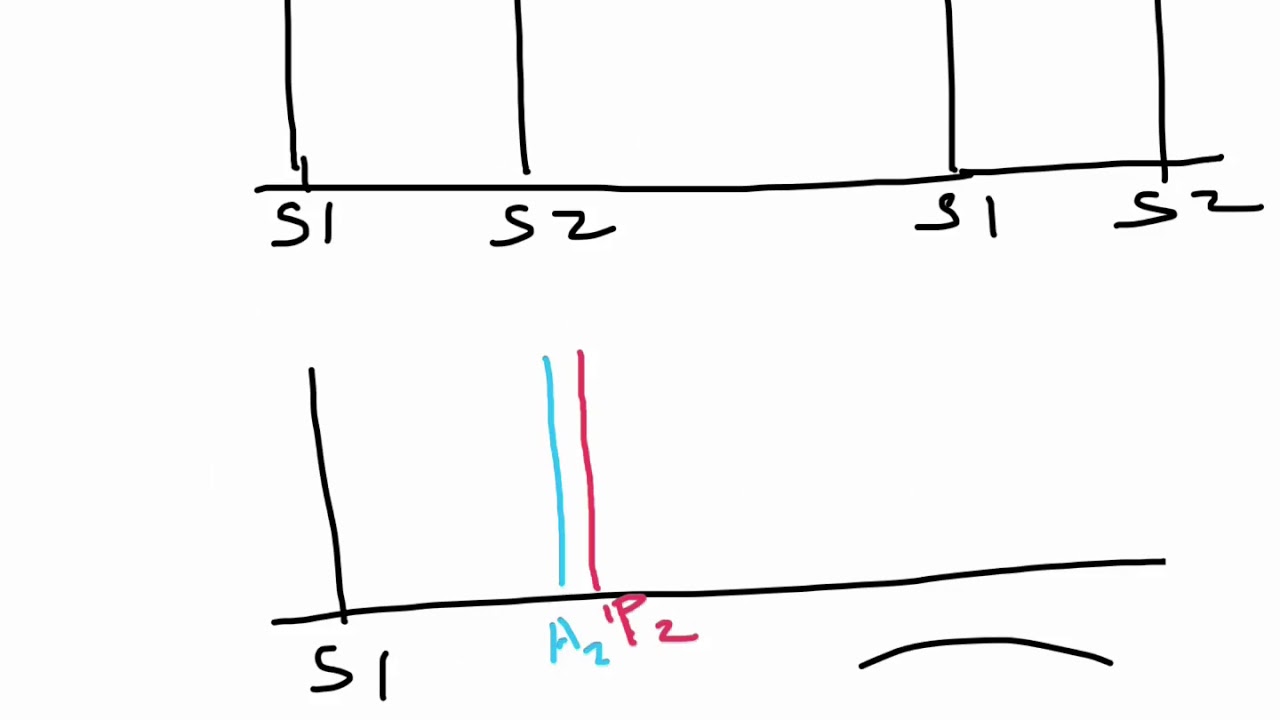 loud P2 ( component of the Second heart sound S2) - YouTube
