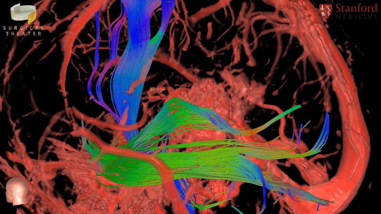Stanford Neurosurgery Virtual Reality Lab's Anatomy in 3D: AVM w DTI ...