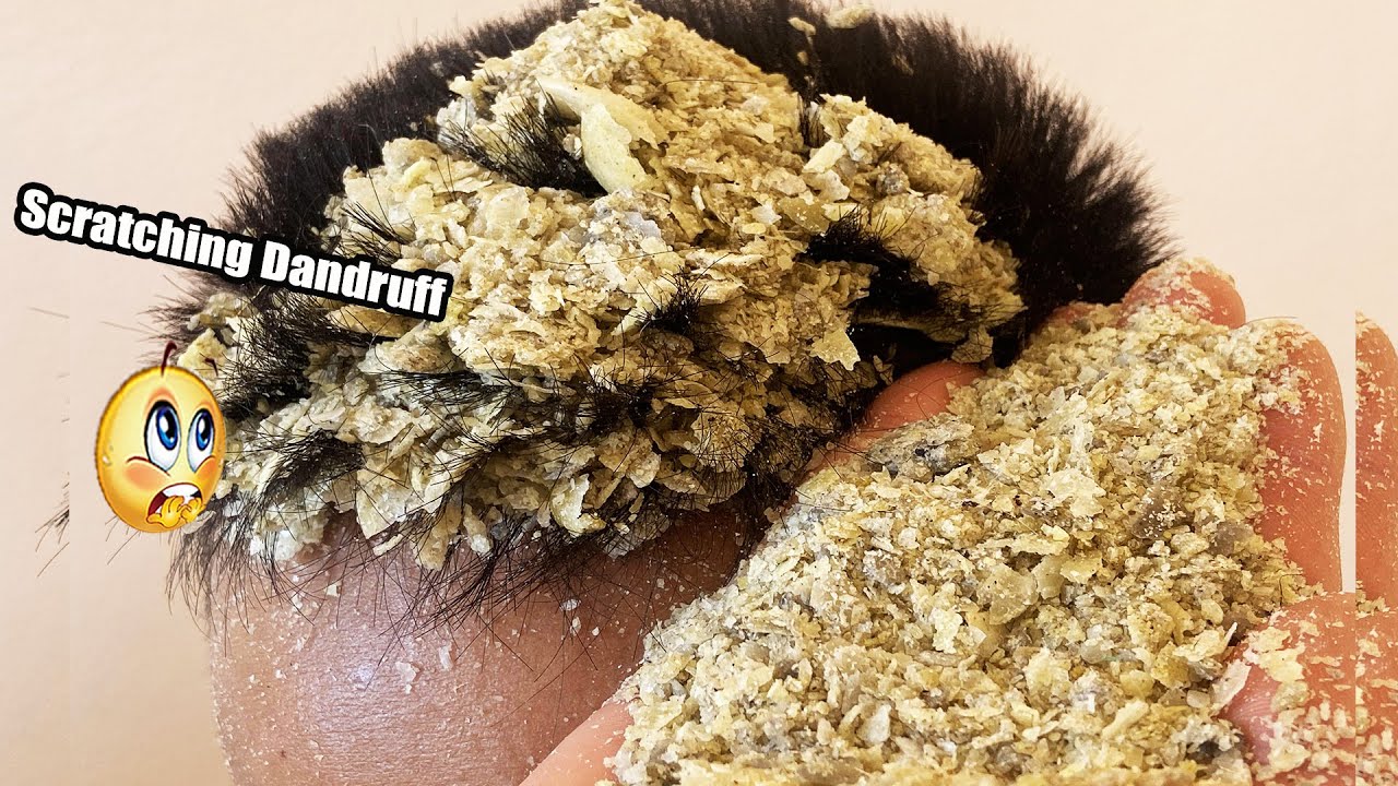 [BOYS DANDRUFF] Itchy psoriasis dandruff Scratching # V126 - YouTube