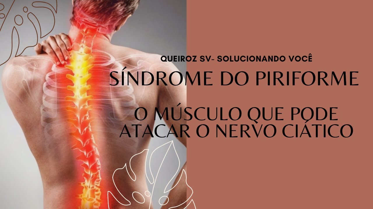 SÍNDROME DO PIRIFORME O MÚSCULO QUE PODE ATACAR O NERVO CIÁTICO - YouTube