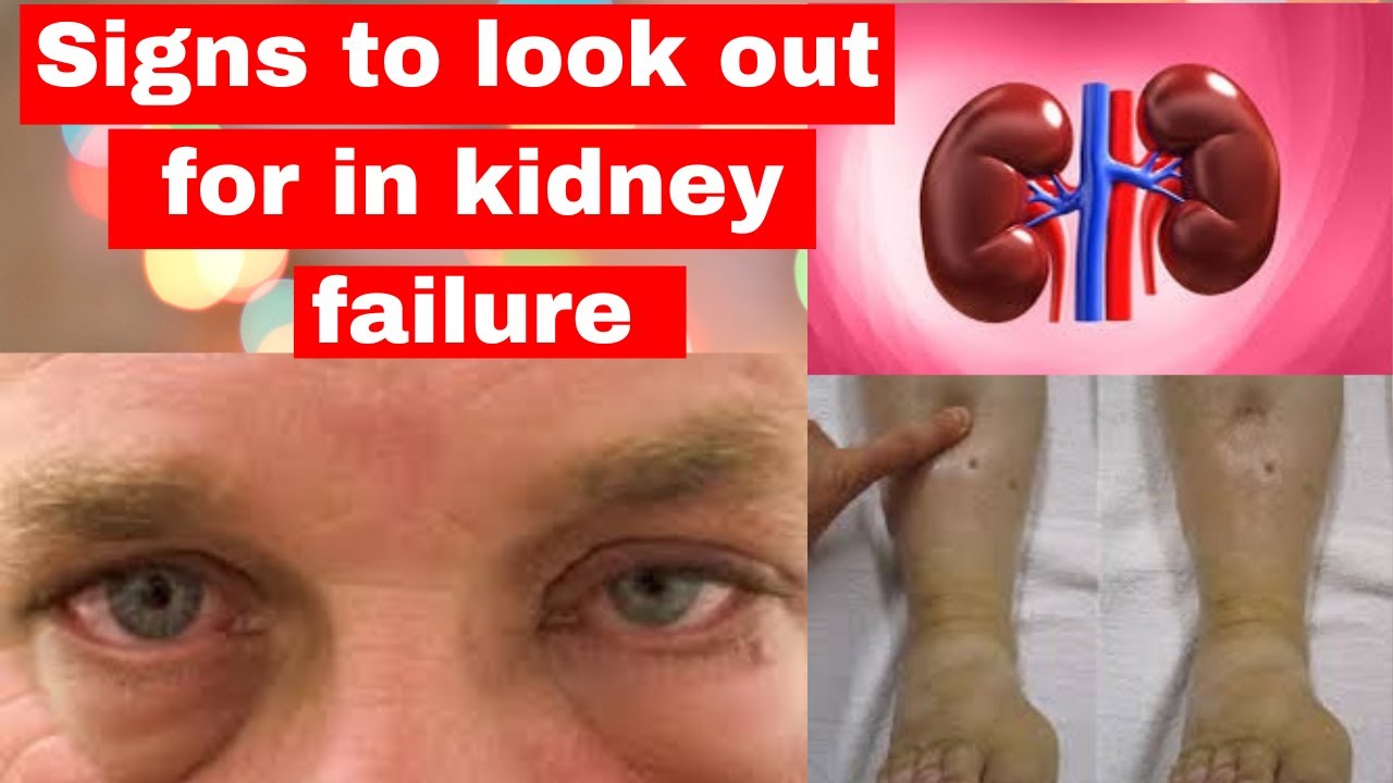 Is your kidney getting damaged?| Signs to look out for in kidney ...