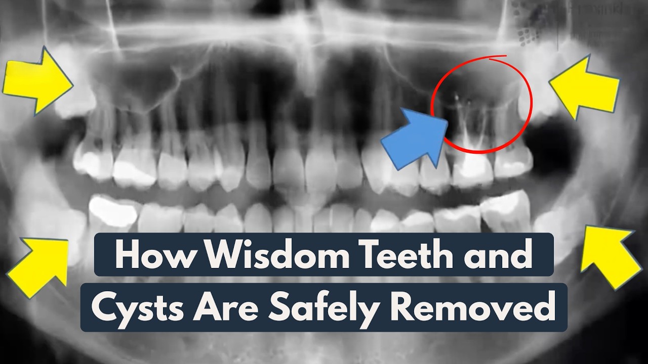 Wisdom Teeth and Cyst Removal - YouTube