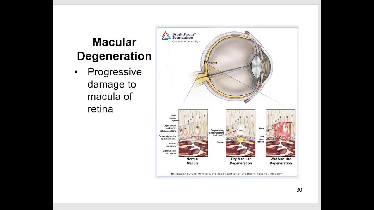 DC of the Eye part 2 - YouTube