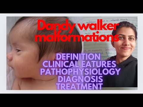 Dandy walker malformation || defination, treatment, pathophysiology ...