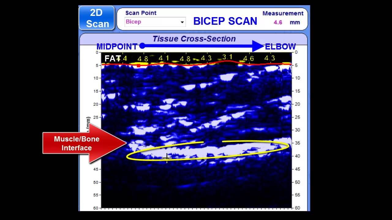 BodyMetrix Ultrasound 2D Scans Show Fat and Muscle Changes - YouTube