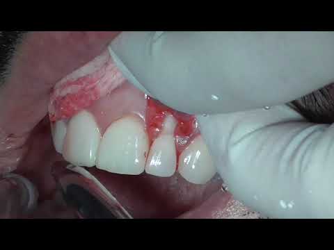 Single Recession Treatment with Stillman Red Cleft - YouTube