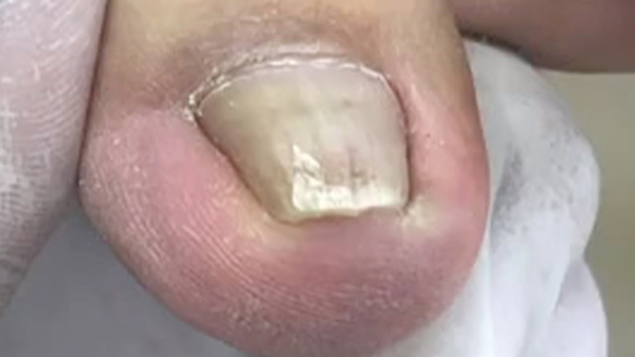 Pedicure Tutorial：Curly Thick Nails 【Pedicure Master Lin Jun】 - YouTube