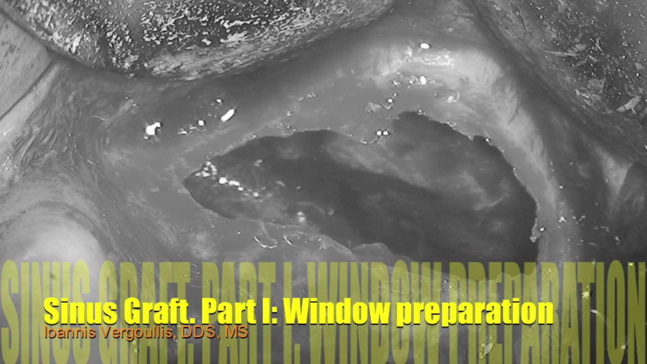 Sinus Graft Part I sinus window preparation - YouTube