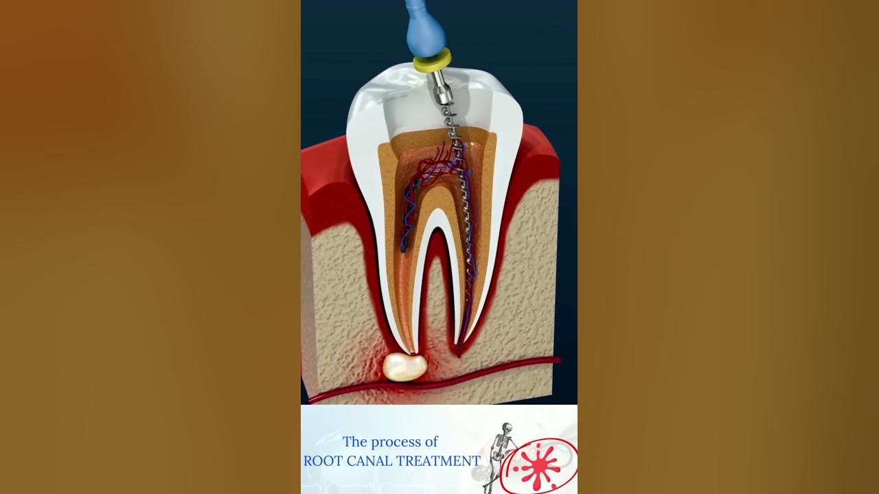 Root Canal Treatment And Tooth Abscess Youtube