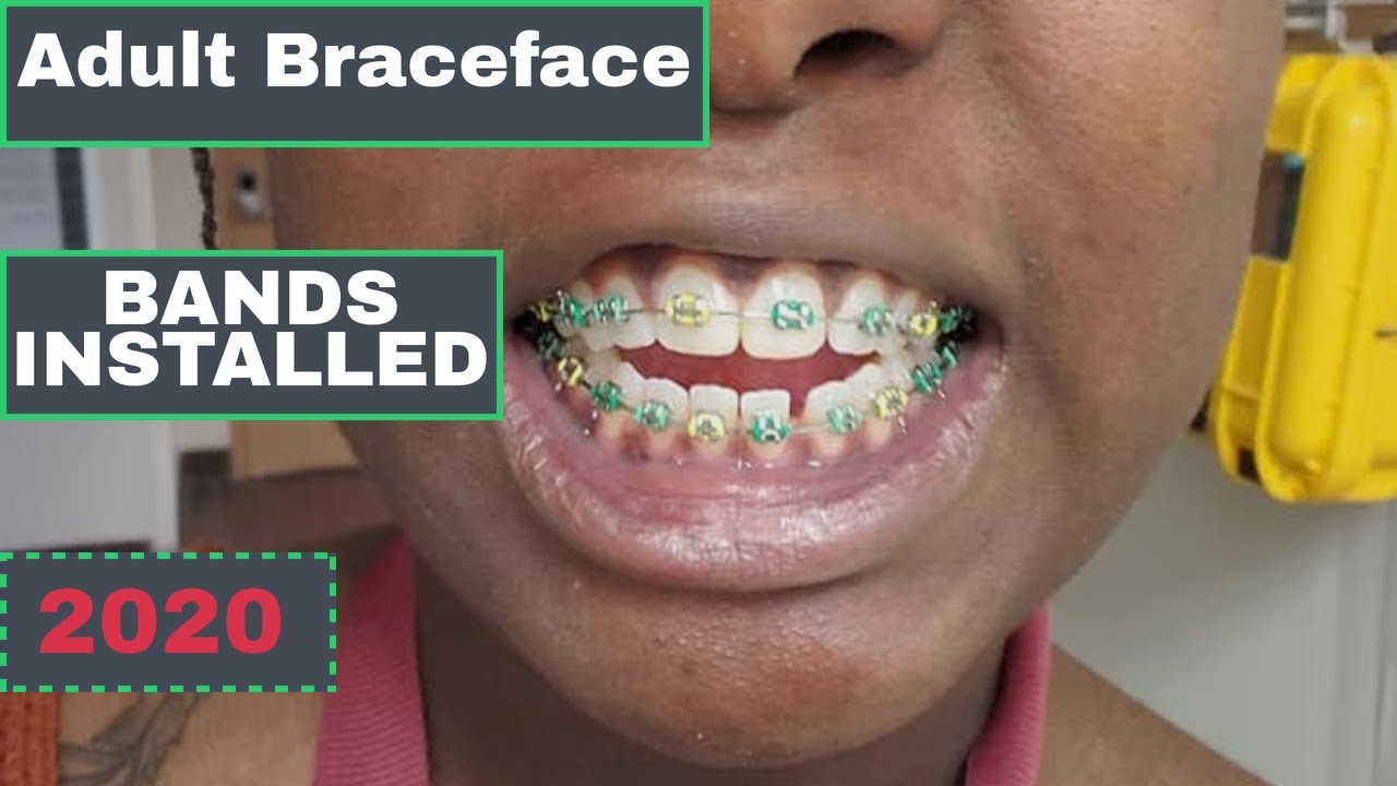 ADULT BRACEFACE|| Spacers out Bands in. Final stage before surgery ...