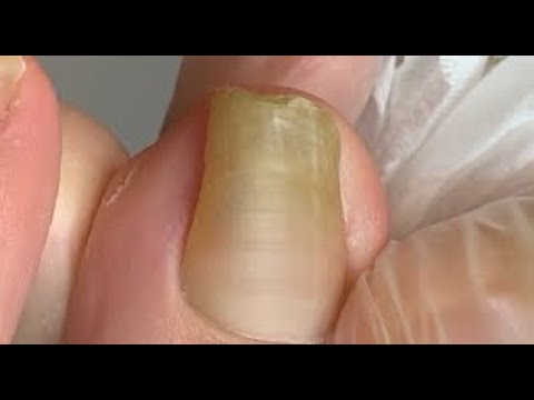 What if you did not cut the nail for months? - YouTube