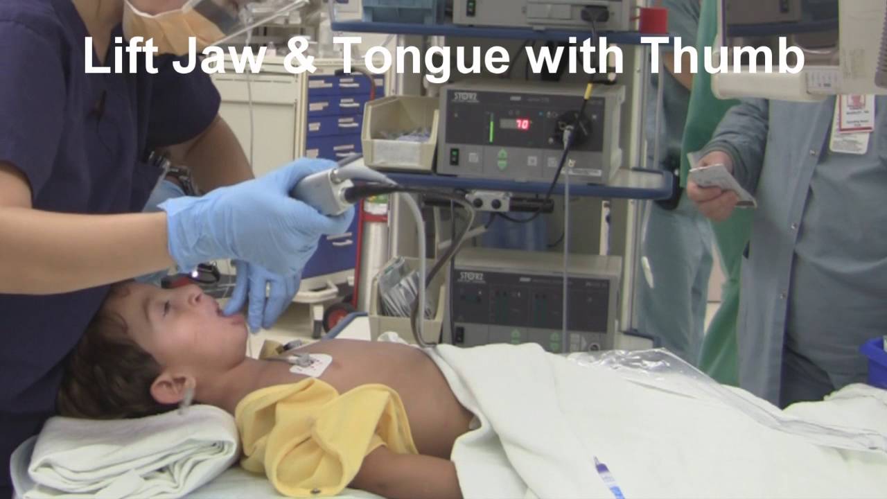 Bonfils Intubation Continuous Loop - YouTube