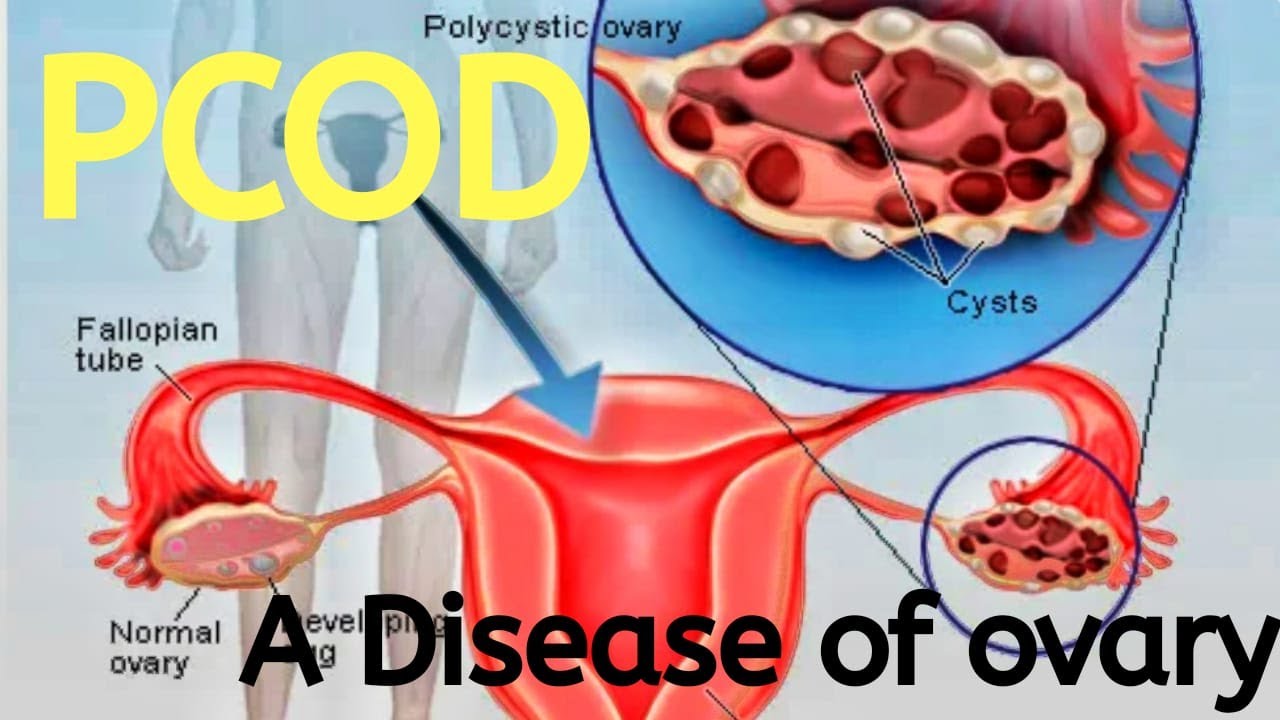 what is PCOD?? || Every girl must watch this || #alchemisacademy - YouTube