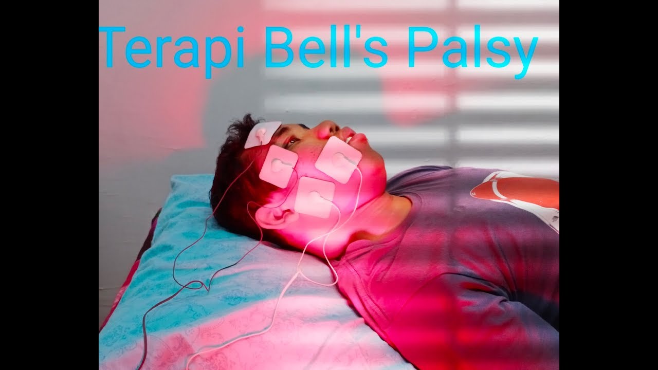 1x terapi langsung bisa menutup Mata (Bell's Palsy) Fisioterapi - YouTube