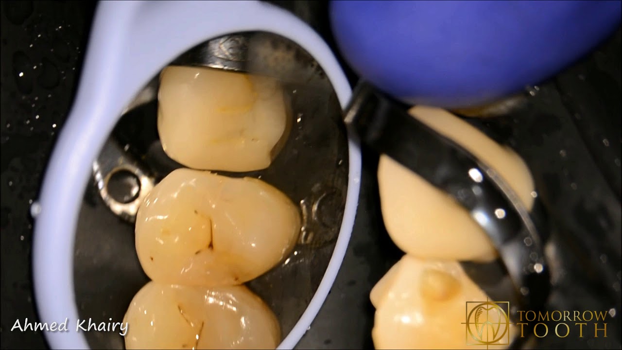 Class V Composite restoration with proximal Extension - YouTube