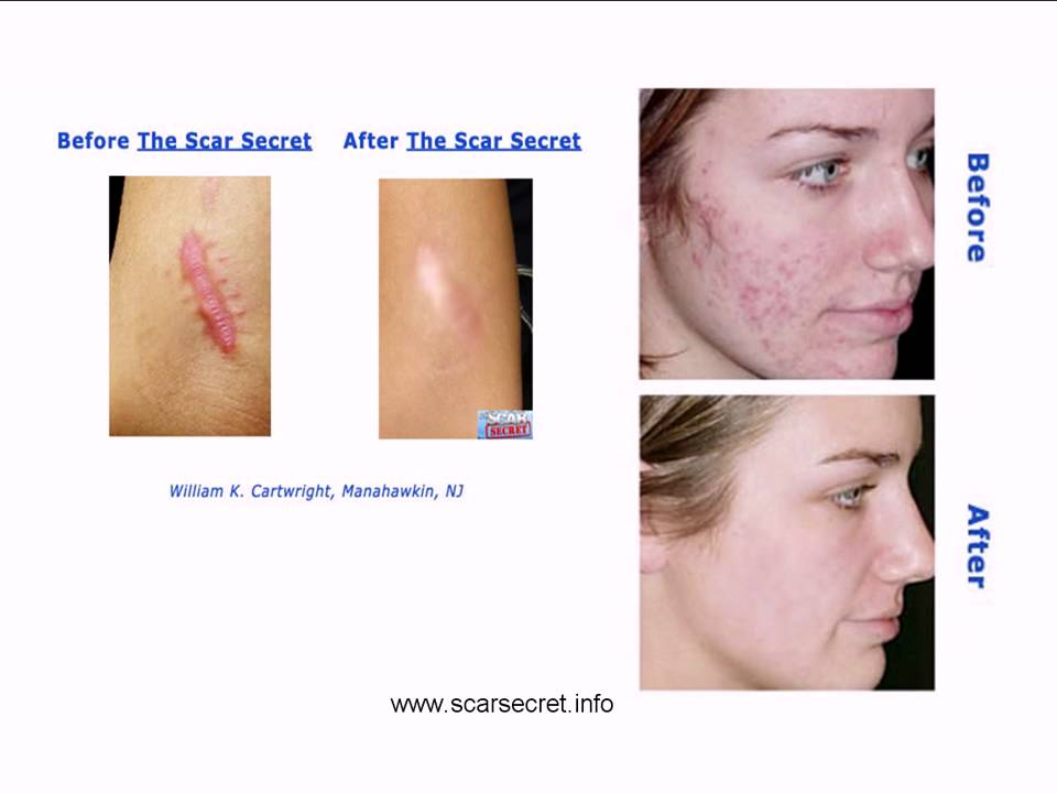 How to remove scars naturally - YouTube
