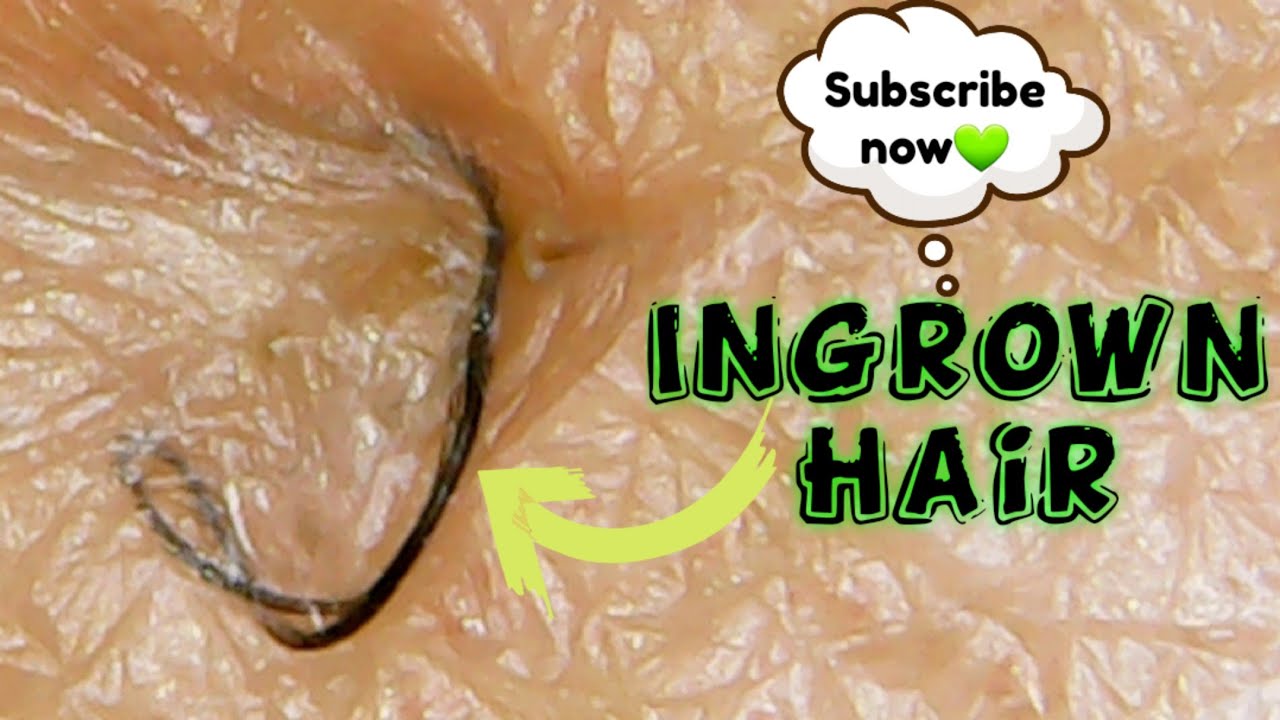 Ingrown Hair Removal On The Groininguinal Short Video Youtube