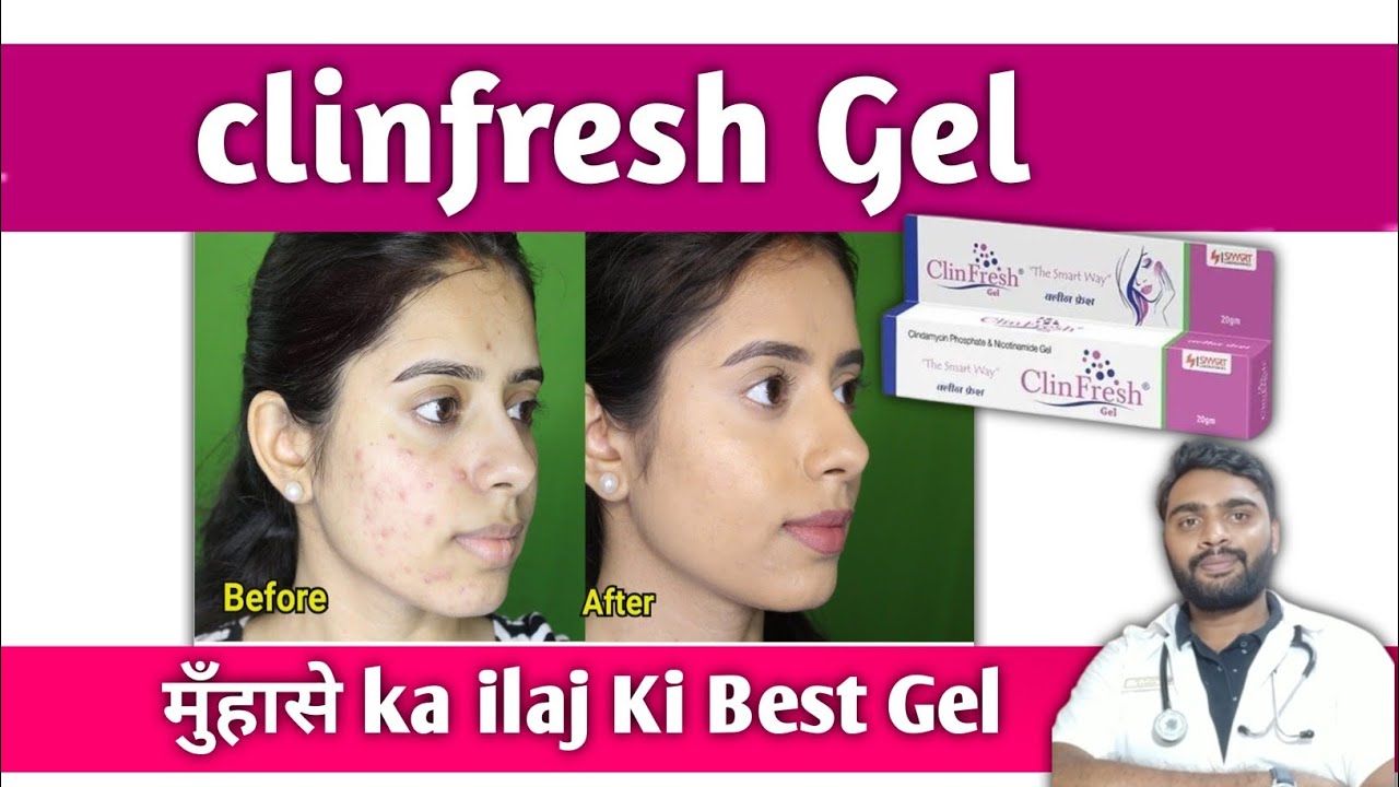 Clinfresh Gel Review | Clinfresh Gel | Clinfresh Gel for Pimples - YouTube