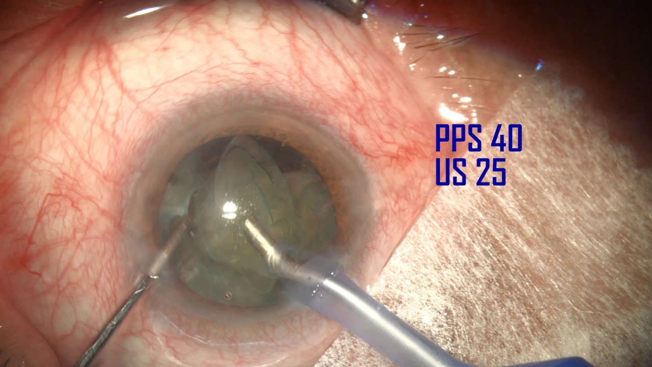 SHORT STUDIES (Zeiss Visalis 100 + Alcon Intrepid balanced tip 3 ...