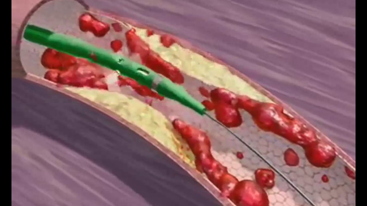 AngioJet animation video - YouTube