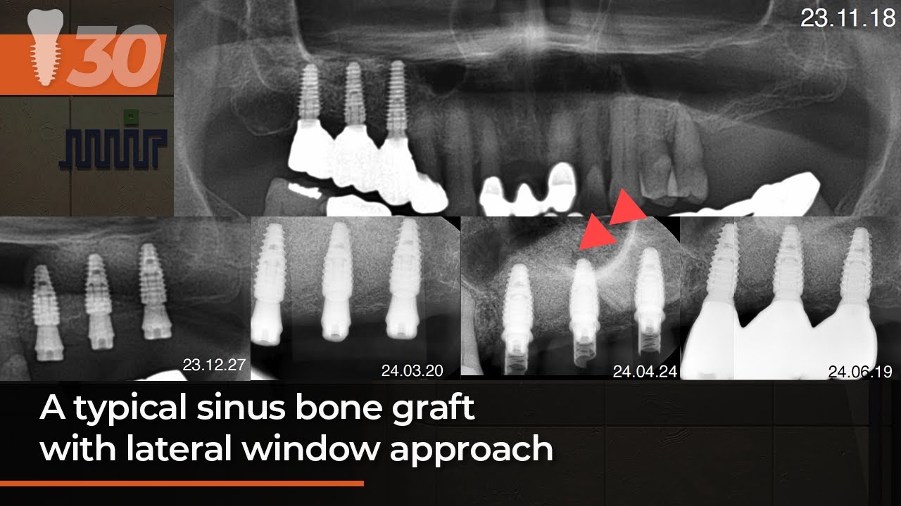 A typical sinus bone graft with lateral window approach - YouTube