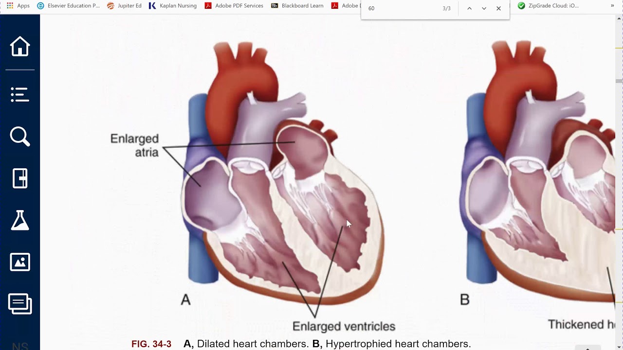 Chapter 34 Heart Failure - YouTube