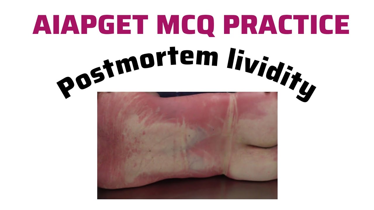 postmortem- lividity in Hindi/ AIAPGET BHMS MCQ - YouTube