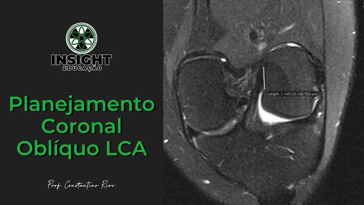 Ressonancia Magnetica Do Ligamento Cruzado Anterior Ligamento