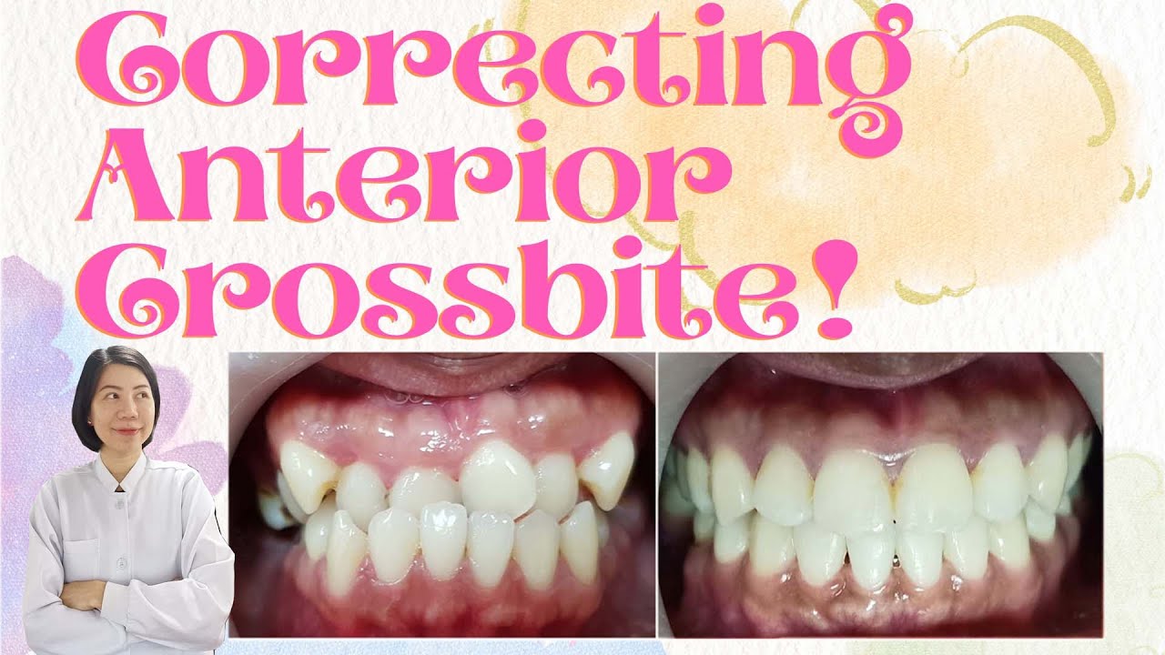 anterior crossbite correction! - YouTube
