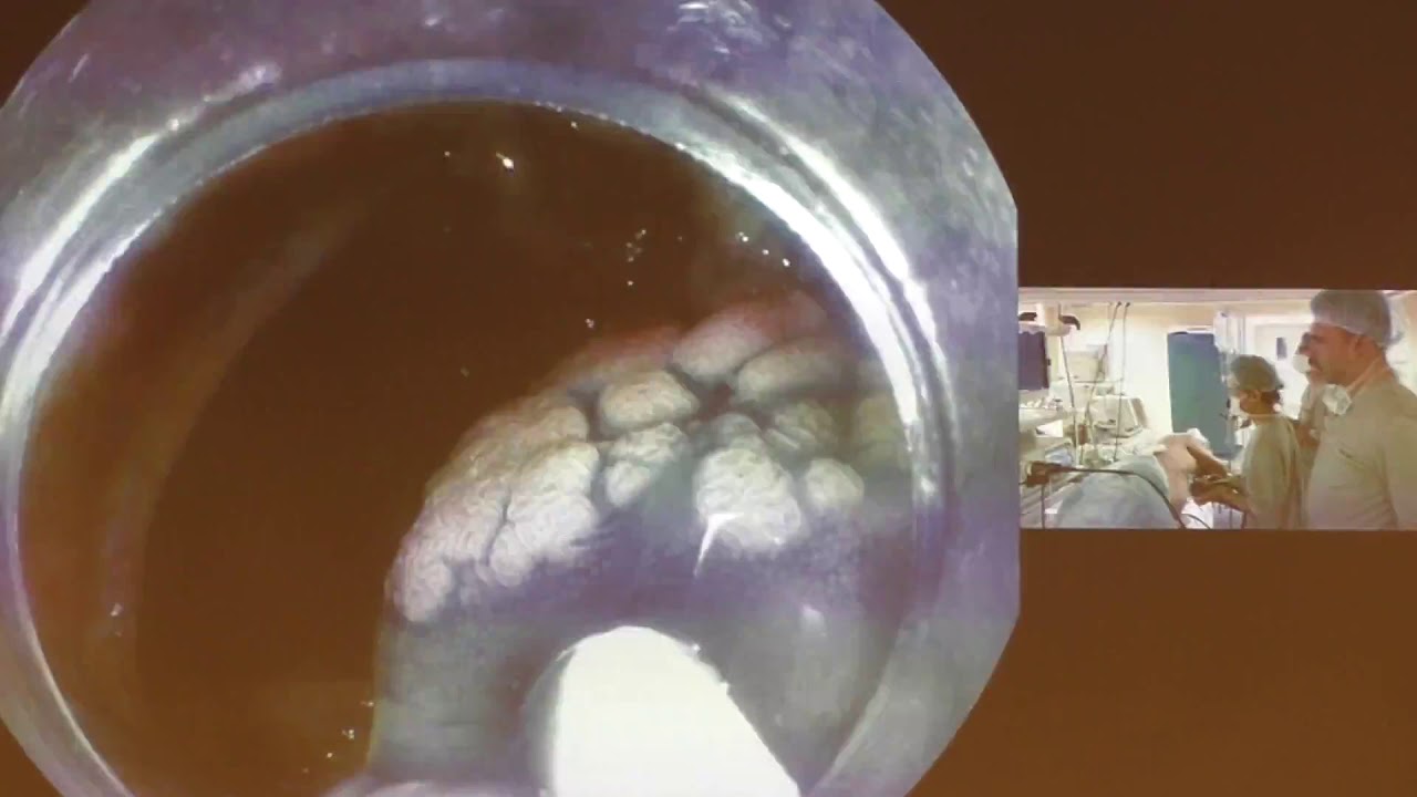 03Live Ken Ohata ESD LST G в толстой кишке через колостому - YouTube