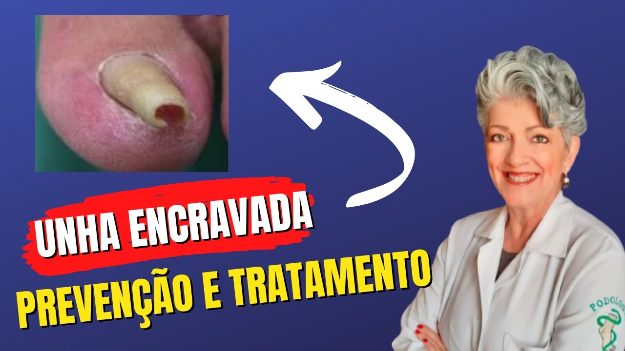 UNHA ENCRAVADA | Prevenção e Tratamento - YouTube