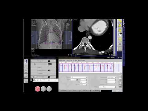 CT Coronary Angiography, Atrial Fibrillation, Left atrial appendage and ...