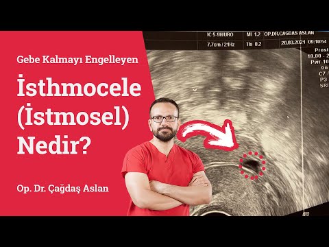 İsthmocele (İstmosel) Nedir?