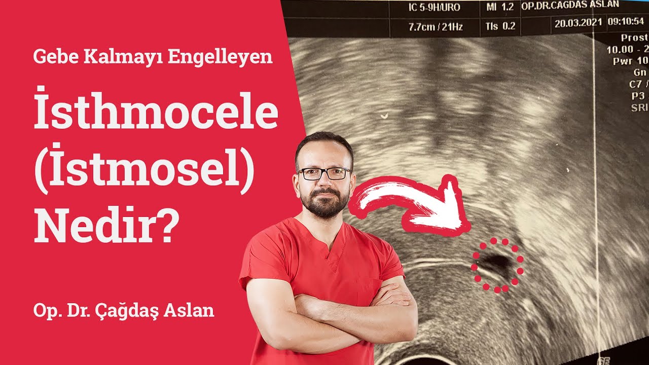 İsthmocele (İstmosel) Nedir? - YouTube