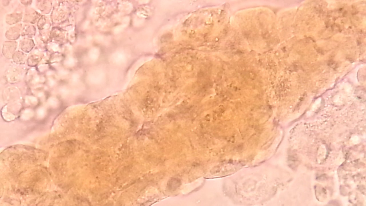 epithelial cast - YouTube