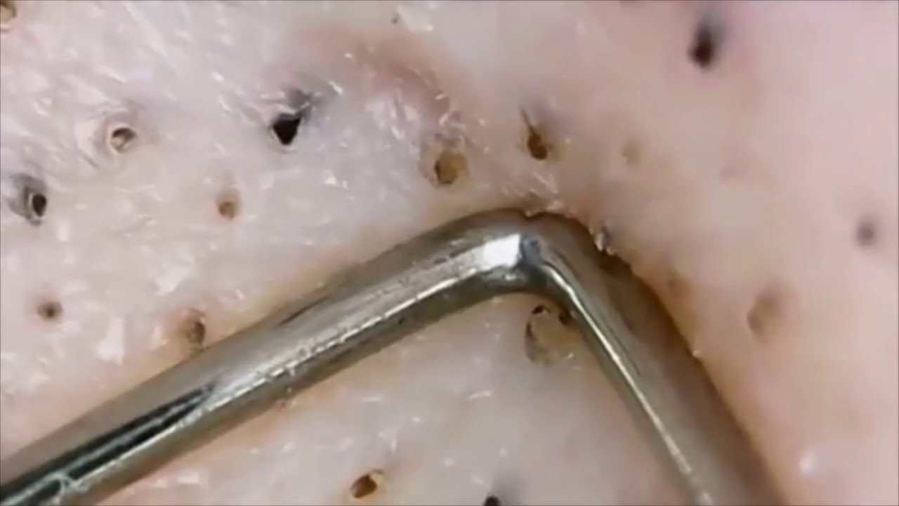 ️ Top 10 blackheads removal satisfying video - YouTube
