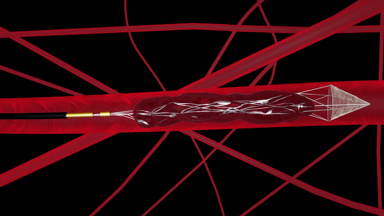 Vasotorq's Neuro Stent with Distal Protection - YouTube