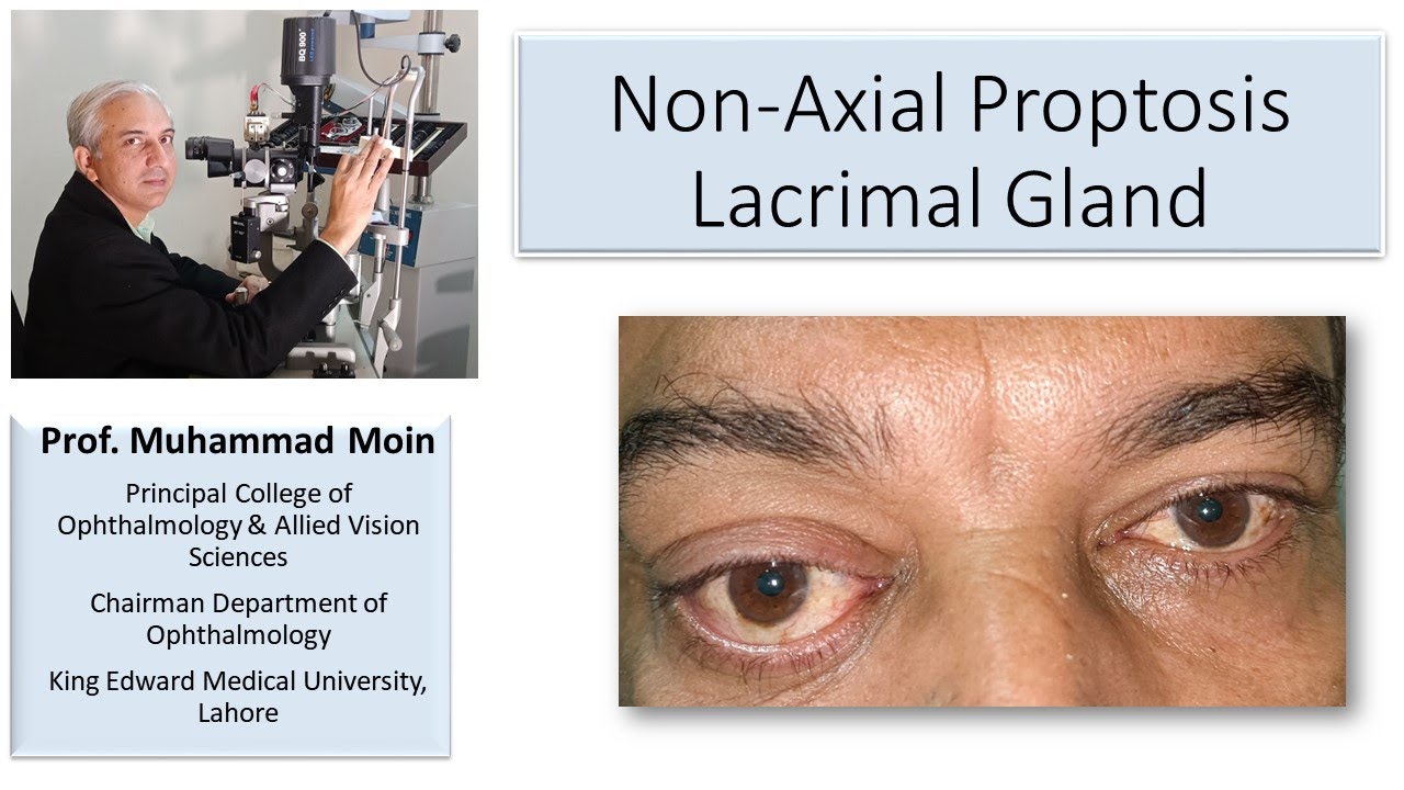How Non-Axial Proptosis is produced by Lacrimal gland tumors? - YouTube