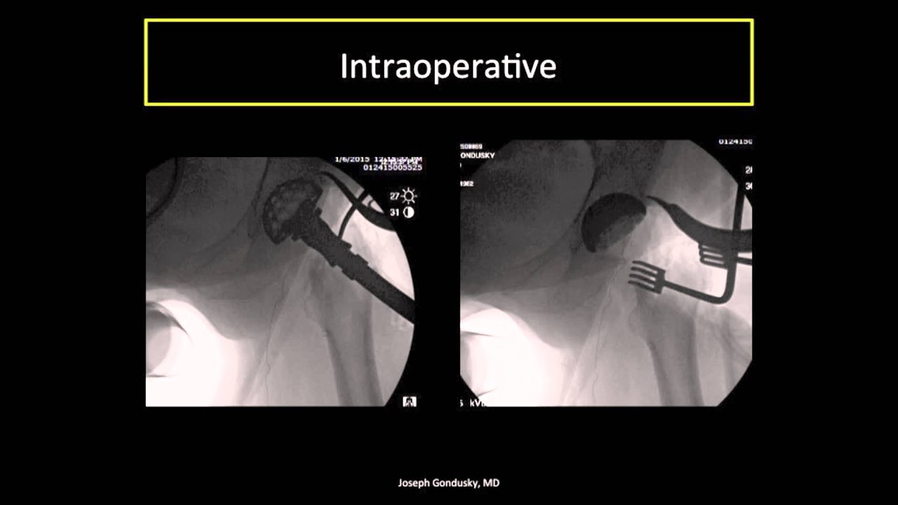 Perfecting Component Placement in Anterior Approach Total Hip ...