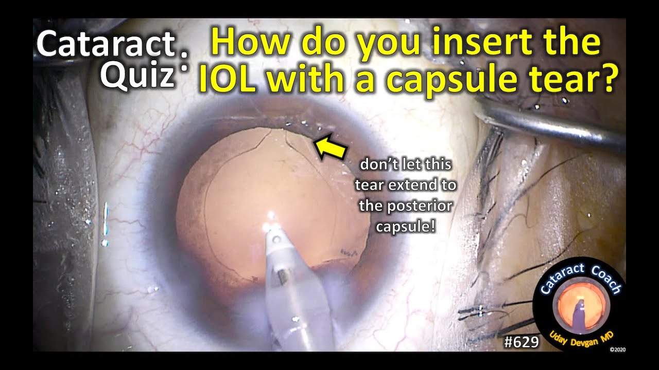 Cataract Quiz How Do You Insert The IOL With A Capsular Tear Present