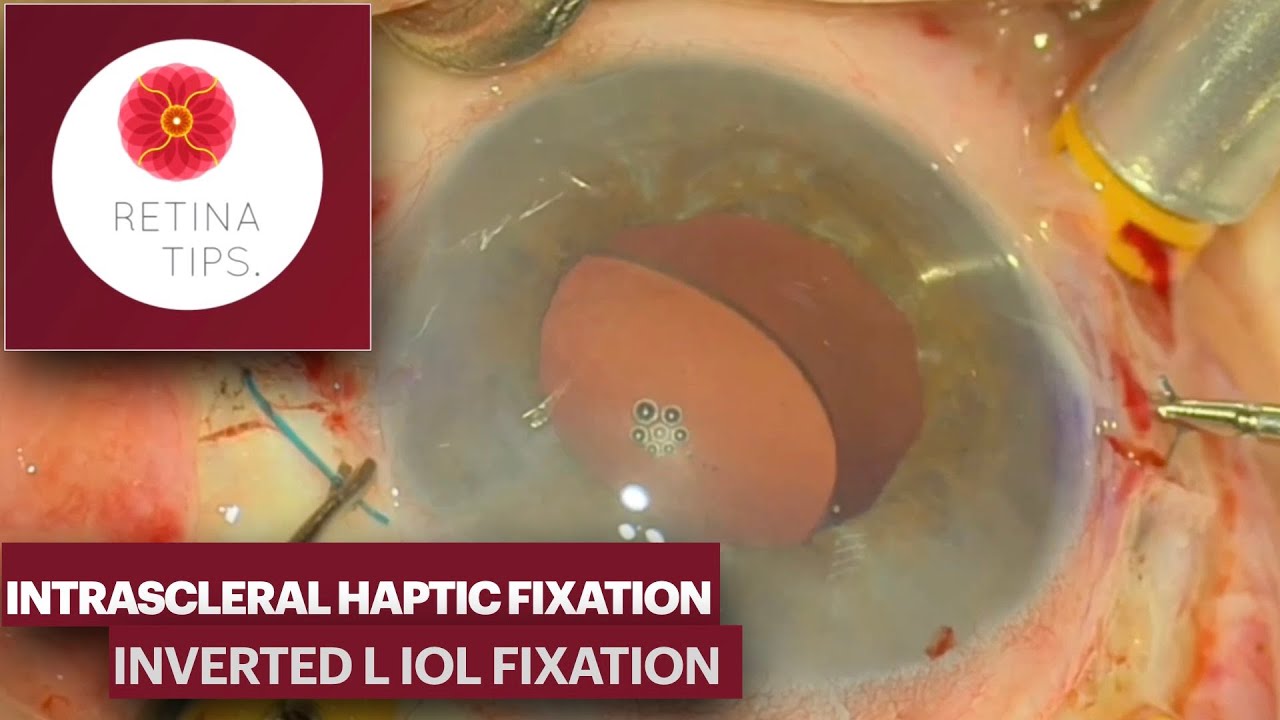 IOL scleral fixation techniques: Inverted L IOL fixation - YouTube