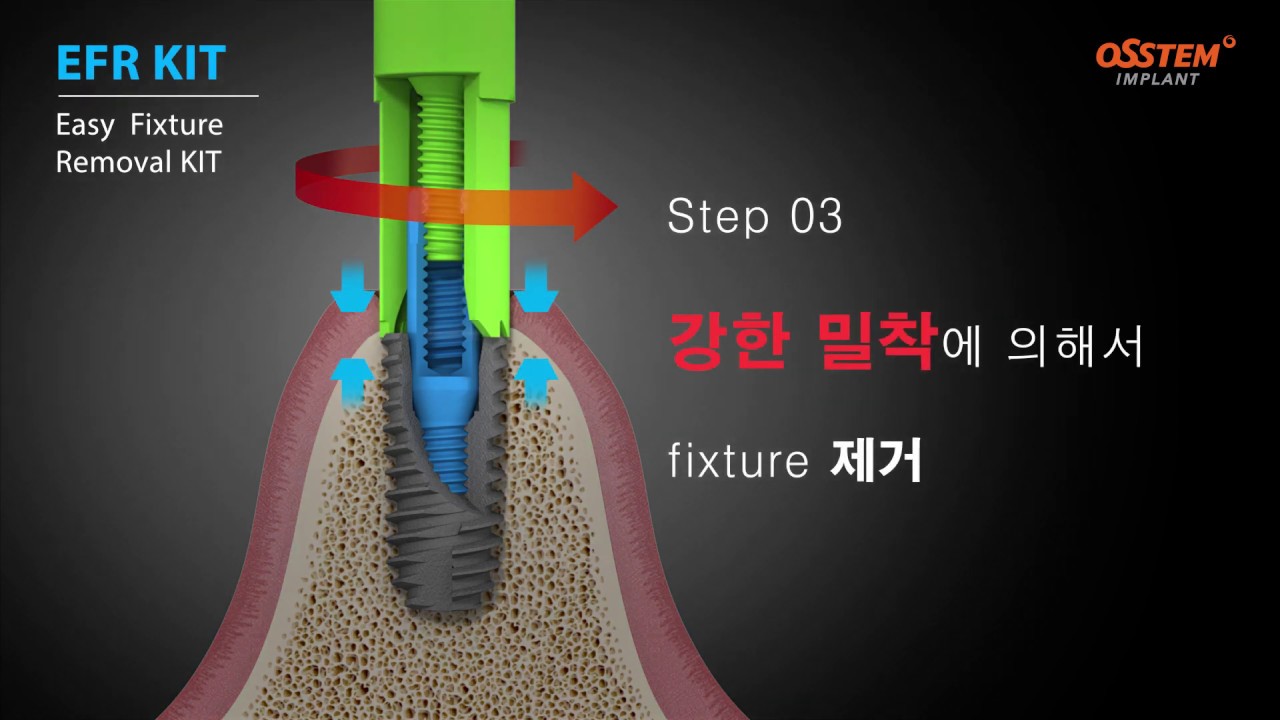 Osstem - EFR KIT - YouTube