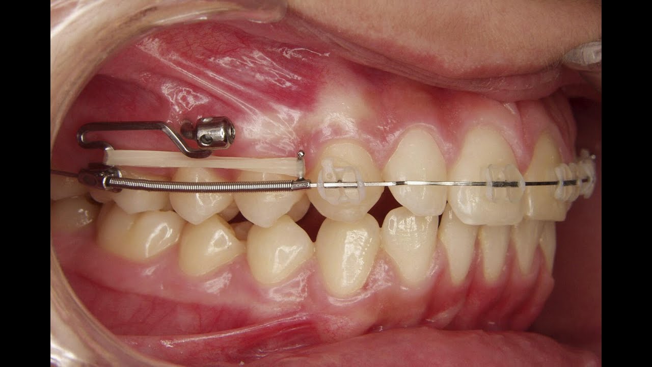 Uni lateral Atalla Distalizing Appliance Assisted by Miniscrew ...