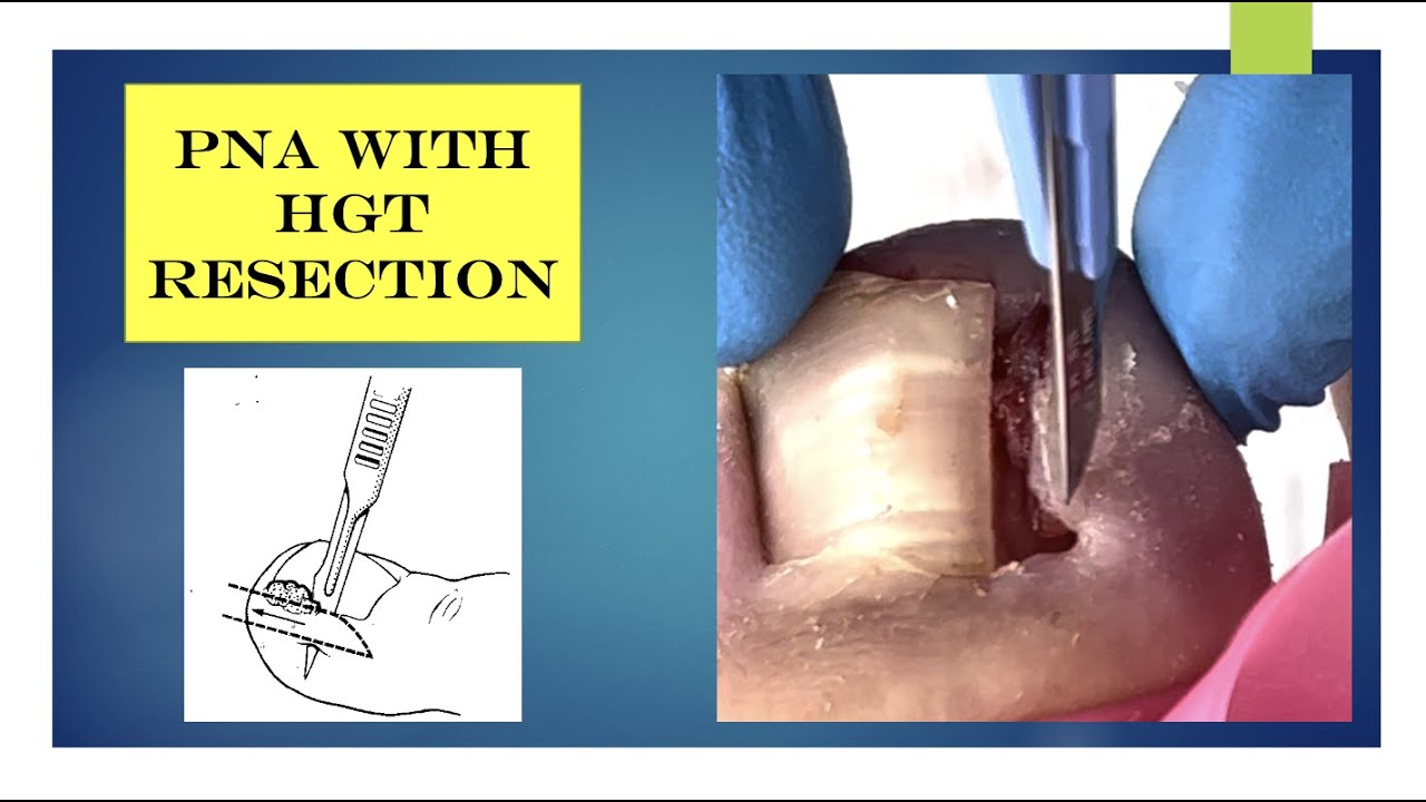 Video - nail surgery with HGT resection - YouTube