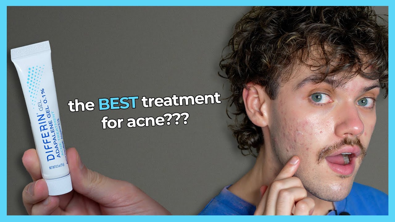 the BEST treatment for acne? my differin adapalene 0.1% acne treatment ...