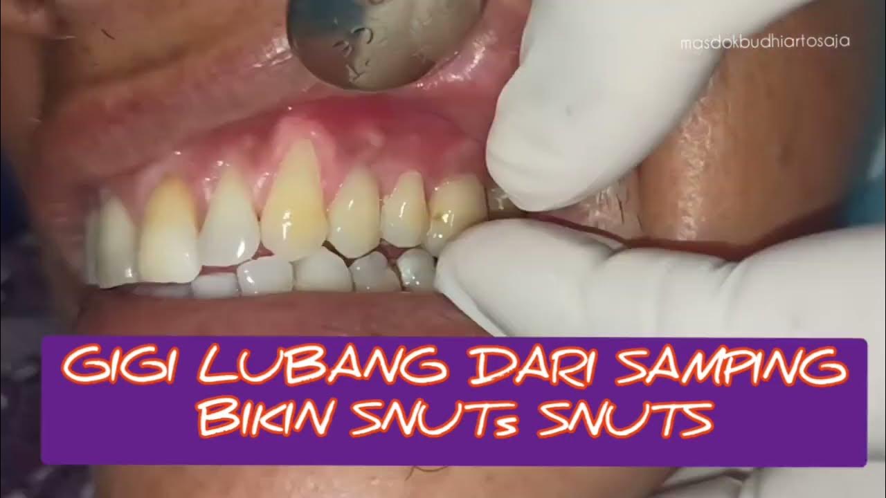 Menambal Gigi Sensitif Karena Berlubang Dari Samping alias Abrasi - YouTube