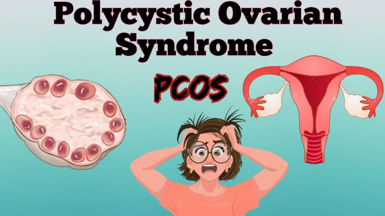 polycystic ovarian syndrome/ PCOS :- meaning,causes , symptoms ...